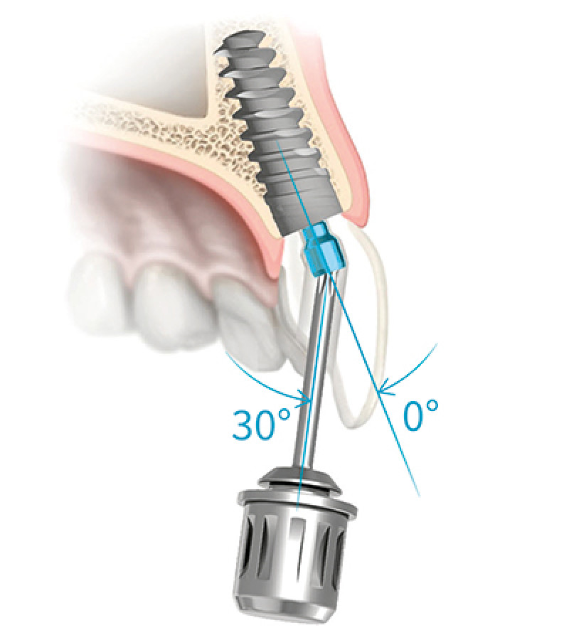 JD Screw Angulated Channel Technology | JDental Care